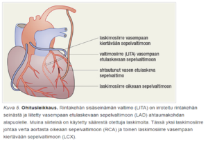 Sepelvaltimoiden angiografia, pallolaajennus ja ohitusleikkaus