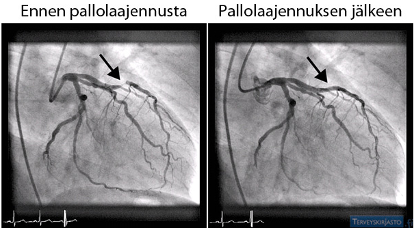 Sepelvaltimoiden angiografia, pallolaajennus ja ohitusleikkaus